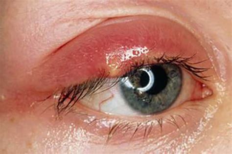Https Divyaeyeclinic Wp Content Uploads Swollen