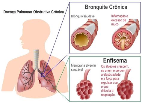 Você sabe o que é DPOC Fisioterapia Home Care
