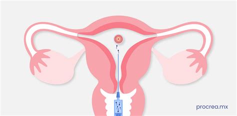 Cu L Es El Precio De La Inseminaci N Artificial En M Xico Procrea