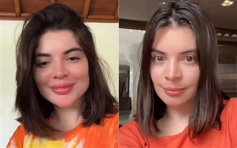 Famosos Buscam A Revers O Do Preenchimento Facial Cada Vez Mais