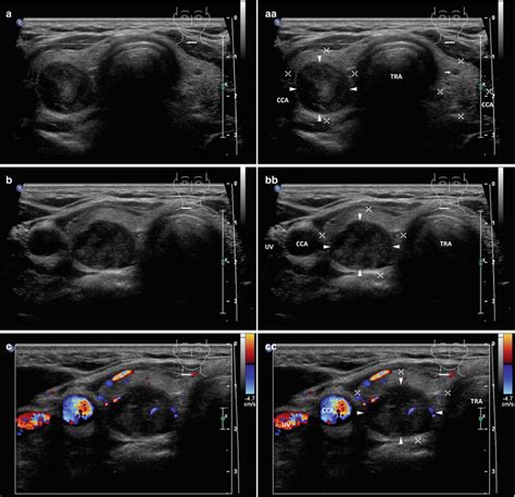 Medullary Thyroid Carcinoma Radiology Key