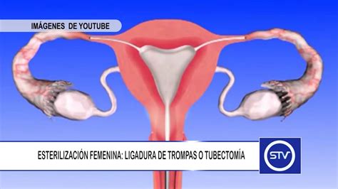 ESTERILIZACIÓN FEMENINA LIGADURA DE TROMPAS O TUBECTOMÍA YouTube