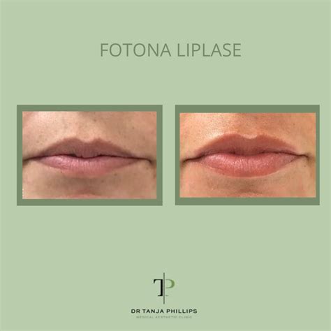 Skin Laser Results Leading Fotona Laser Specialist Dr Tanja