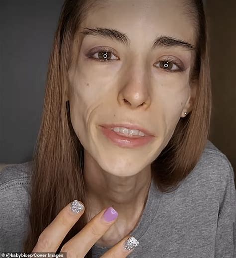 Arizona Woman 27 Has Lived With Anorexia For More Than Half Her Life