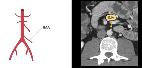 Abdominal CT Abdominal Arteries LITFL Radiology Library