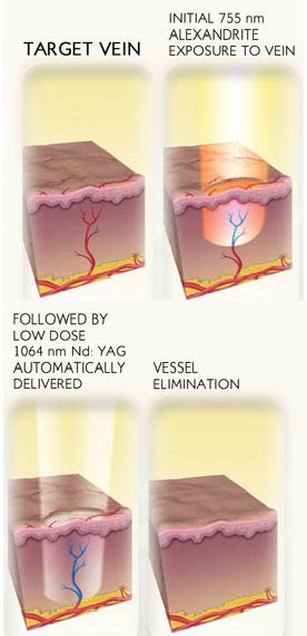 How Does Vascular Treatment Work PureMed Laser Clinic The Most