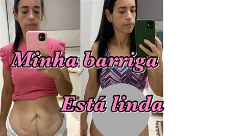 42 dias de ABDOMINOPLASTIA EM ÂNCORA fui ao médico Minha Alimentação