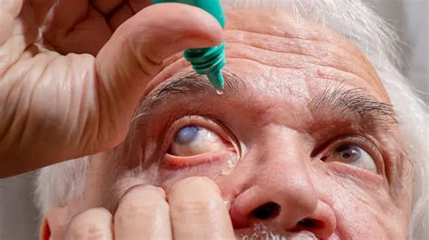 Pc Glaucoma Patients At Risk Of Blindness Survey The Daily Star
