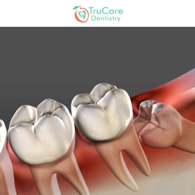 Causes Symptoms Of Impacted Wisdom Teeth Dentist In Roswell GA