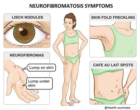 Neurofibromatosis Types Causes Symptoms Diagnosis Health Fitness