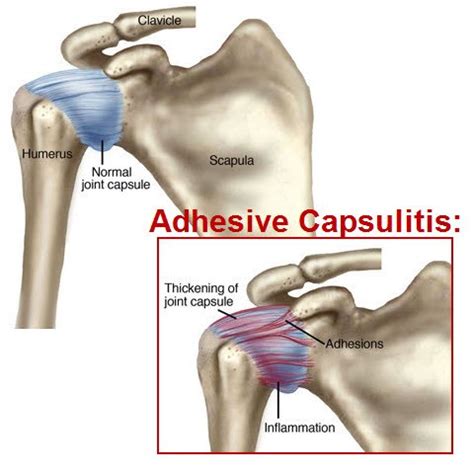 How To Cure Frozen Shoulder Adhesive Capsulitis Korehab Clinic