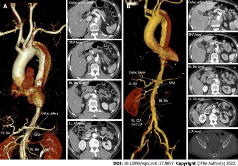 Iatrogenic Aortic Dissection During Right Transradial Intervention In A
