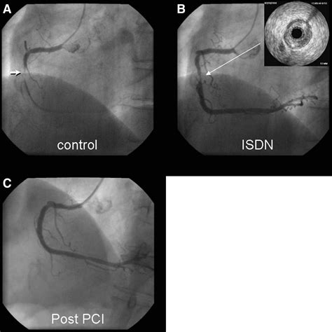 Rapid Progression Of Coronary Atherosclerosis By Coronary Artery Spasm