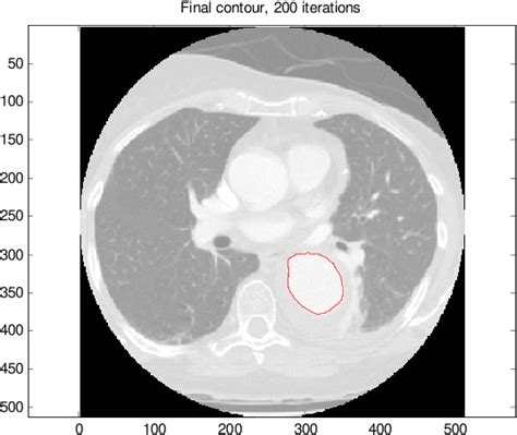 figure 1 from medical image segmentation using deformable model and local fitting binary