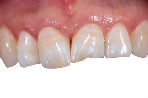 Manchas Brancas Nos Dentes Saiba Como Corrigir