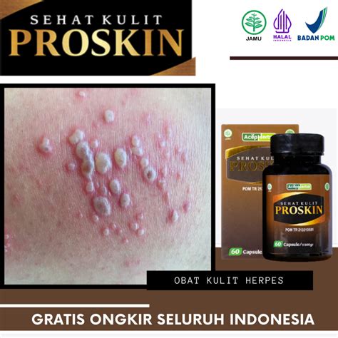 Jual Proskin Obat Gatal Kulit Herpes Herpes Genital Herpes Simplex