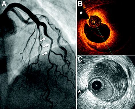 Spontaneous Coronary Artery Dissection Circulation