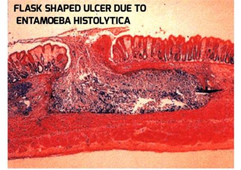 Flask Shaped Ulcer Due To Entamoeba Histolytica Neet Pg