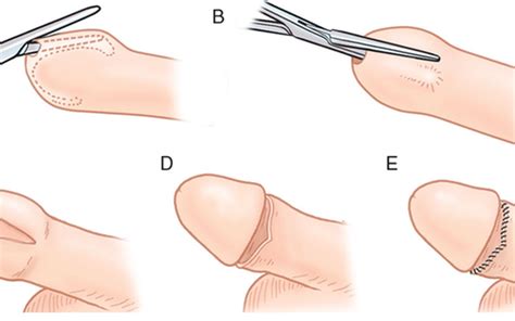 Lợi Ích Và Tác Hại Của Cắt Bao Quy Đầu Bị Cắt Oan Uổng Ảnh Hưởng Không