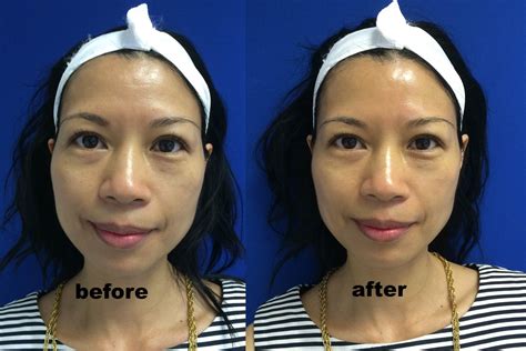 Hydrafacial Процедура Отзывы Фото До И После Telegraph