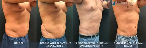 Best Safe Lipo Specials Near Me Nj Power Assisted Liposuction Cost