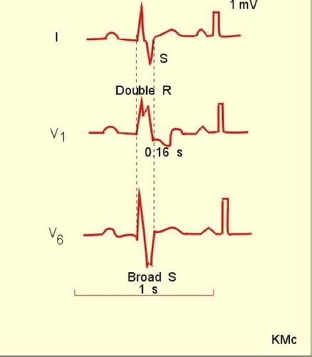 Bundle Branch Blocks Valves Hemiblock Flashcards Quizlet