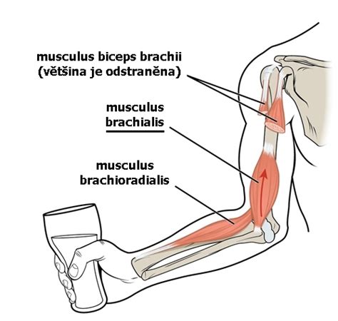 Musculus brachialis Medicína nemoci studium na 1 LF UK