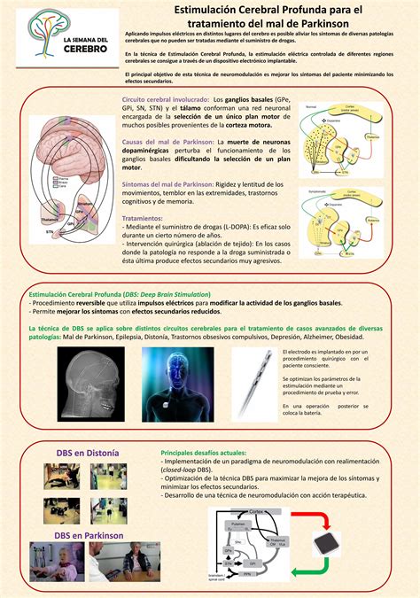 PDF Estimulación Cerebral Profunda para el tratamiento del mal