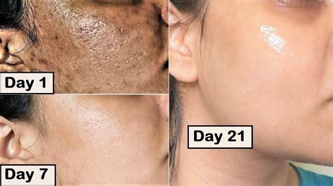 Repair Damaged Skin Close Large Open Pores Remove Dark Spots Hyper