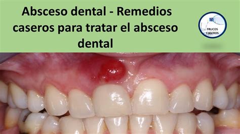 Absceso Dental Remedios Caseros Para Tratar El Absceso Dental YouTube