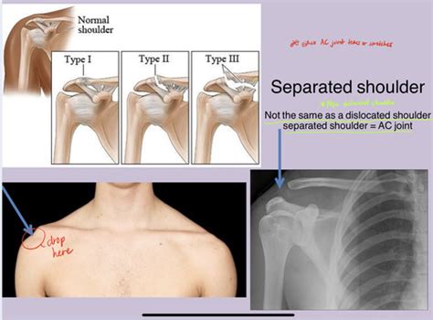 Ims Anatomy Exam Upper Extremity Scapula Shoulder Axilla Elbow