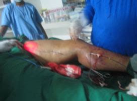 Dr Rajesh Vascular Surgeon Vascular Endovascular Surgery