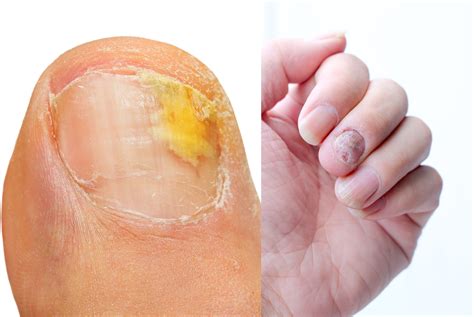 Hongos En Las Uñas De Las Manos
