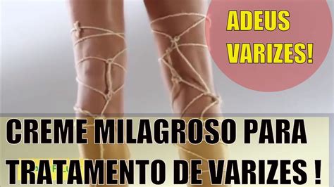 Variflux Creme Para Varizes E Vasos Tratamento Milagroso Para Varizes