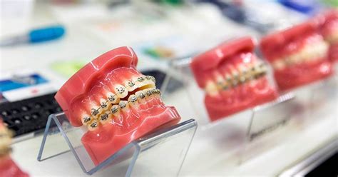 Diastema Causes And Treatment For Gaps Between Teeth