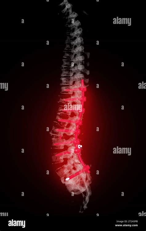 CT Scan Of Thoracic And Lumbar Spine 3d Rendering Showing Pedicle Screw
