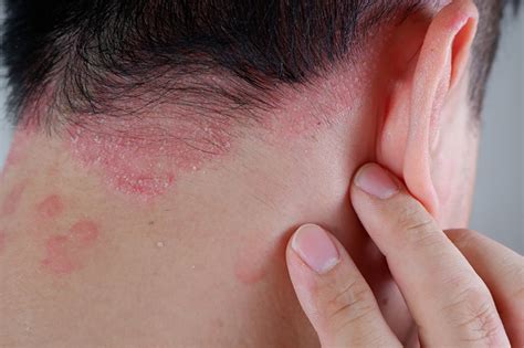 Psoriazis Cauze Simptome Tratament