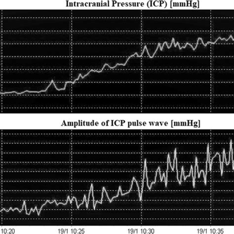 Example Of An Intracranial Pressure Icp Curve From Infusion Test