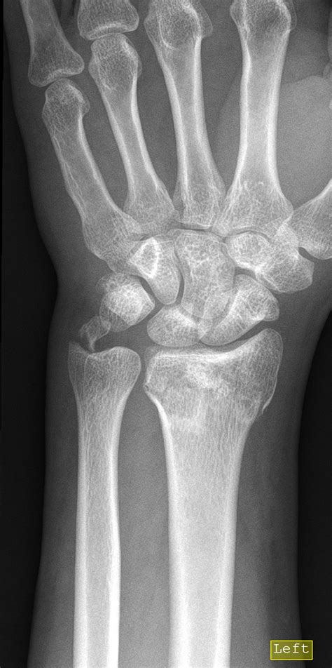 Distal Radial And Ulnar Styloid Fractures Image Radiopaedia Org