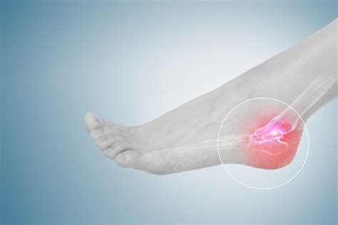 Tendinitis De Tobillo O Peroneal S Ntomas Y Tratamientos Eficaces