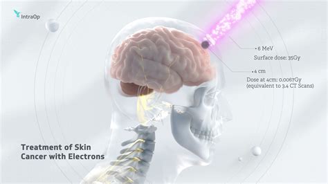 Benefits Of Electrons Vs X Rays For Treatment Of Skin Cancer Youtube
