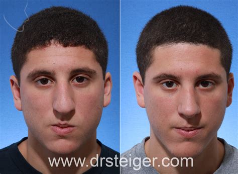 Nose Job Men