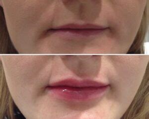 Lip Filler Before And After Photos And Results The Daily Glimmer