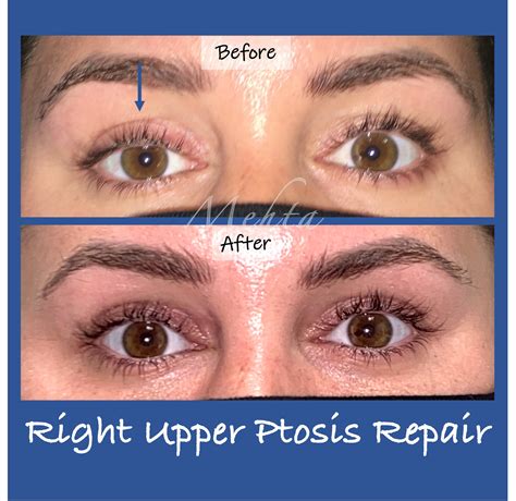Ptosis Surgery DC How To Fix Droopy Eyelids Washington Eye
