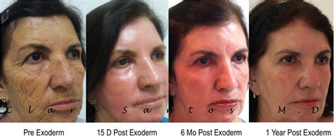 Peeling De Fenol Antes E Depois Pre O Pros E Contras