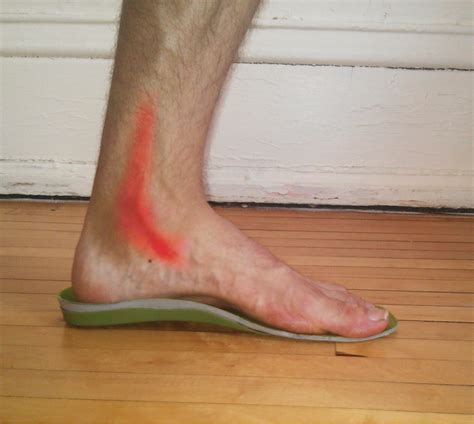 Posterior Tibial Tendon Tear Exercises Porn Sex Picture