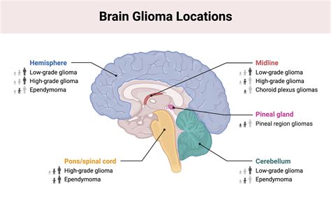 Brain Glioma Locations BioRender Science Templates