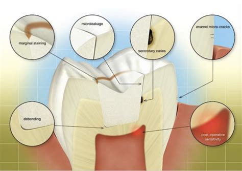 Bulk Fill Composite Dental Materials Flashcards Quizlet
