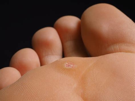 Verruche Cosa Sono E Come Curarle Donna Moderna