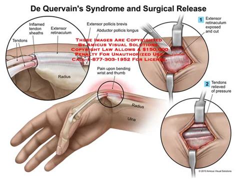 De Quervain S Syndrome And Surgical Release